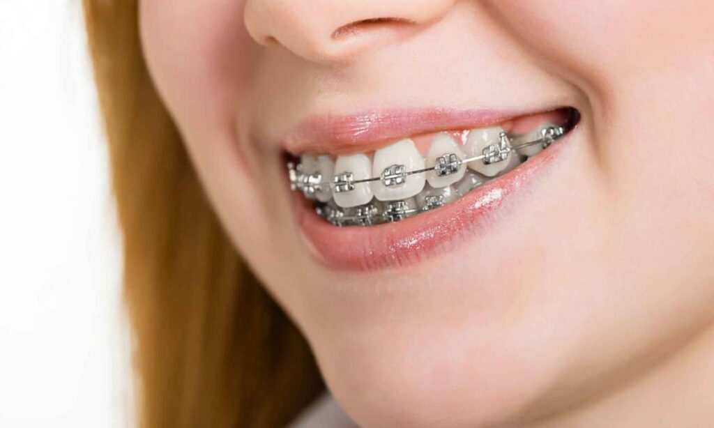 Straighten Your Teeth with Orthodontic Braces at Coit Dental